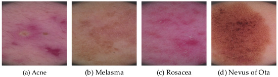 Electronics | Free Full-Text | A Skin Disease Classification Model ...
