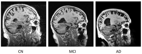 An Approach for Classification of Alzheimer’s Disease Using Deep Neural ...