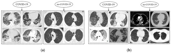 COVID-ResNet: COVID-19 Recognition Based on Improved Attention ResNet