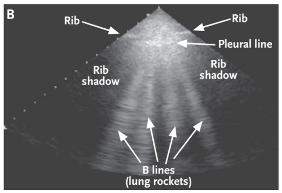 Artifact Detection in Lung Ultrasound: An Analytical Approach