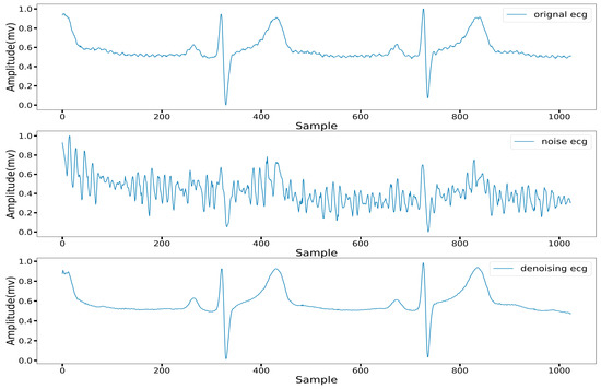 ECG Signal Denoising Method Based on Disentangled Autoencoder