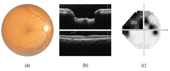 A Study of the Interpretability of Fundus Analysis with Deep Learning ...