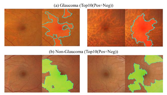 A Study of the Interpretability of Fundus Analysis with Deep Learning ...