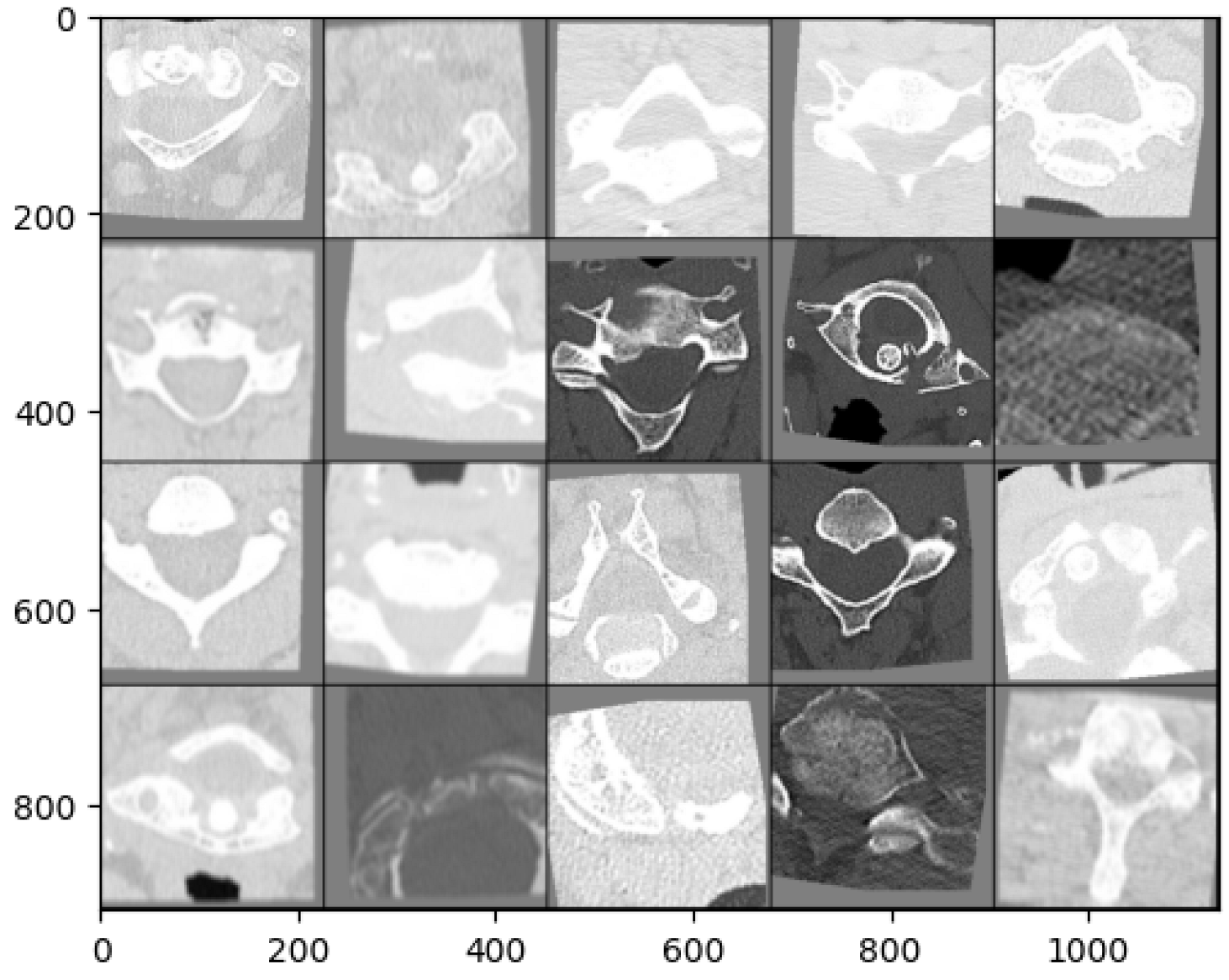 Deep Learning and Cloud-Based Computation for Cervical Spine Fracture ...
