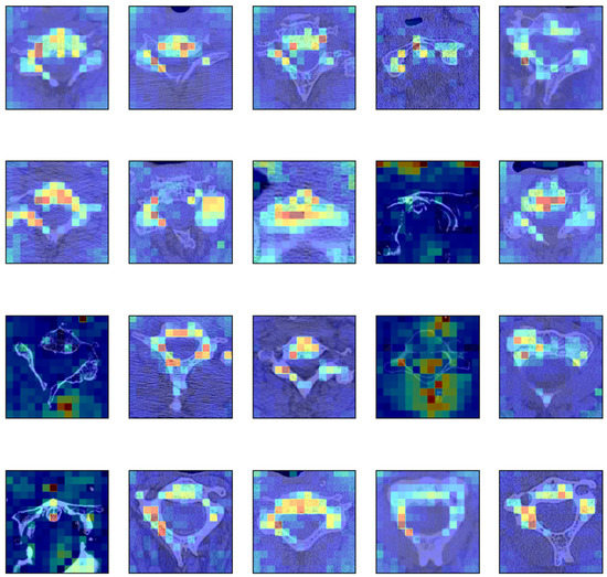 Electronics Free Full Text Deep Learning And Cloud Based Computation For Cervical Spine