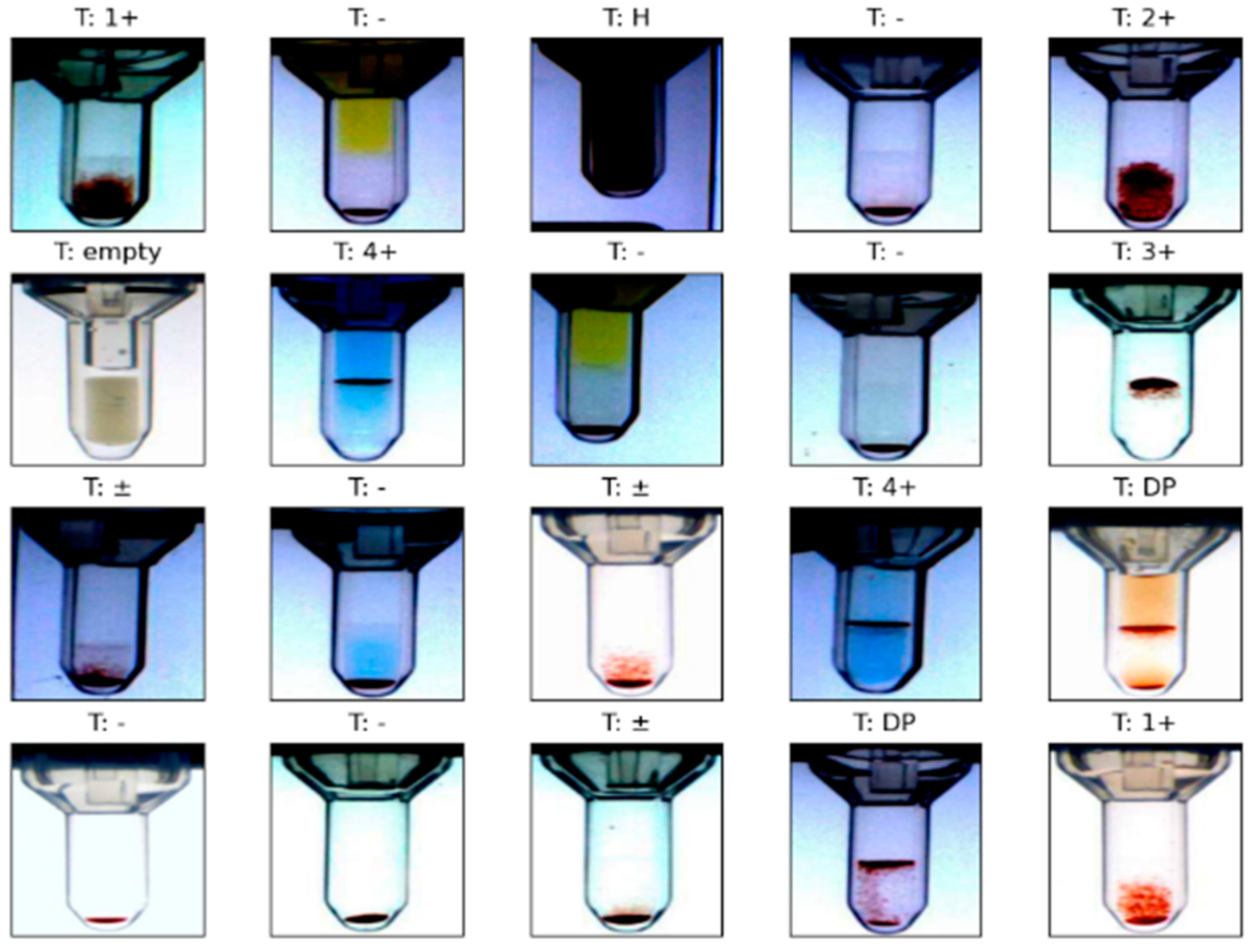 Blood Group Interpretation Algorithm Based on Improved AlexNet