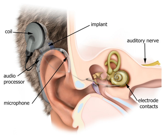 Machine Learning and Cochlear Implantation: Predicting the Post-Operative Electrode Impedances