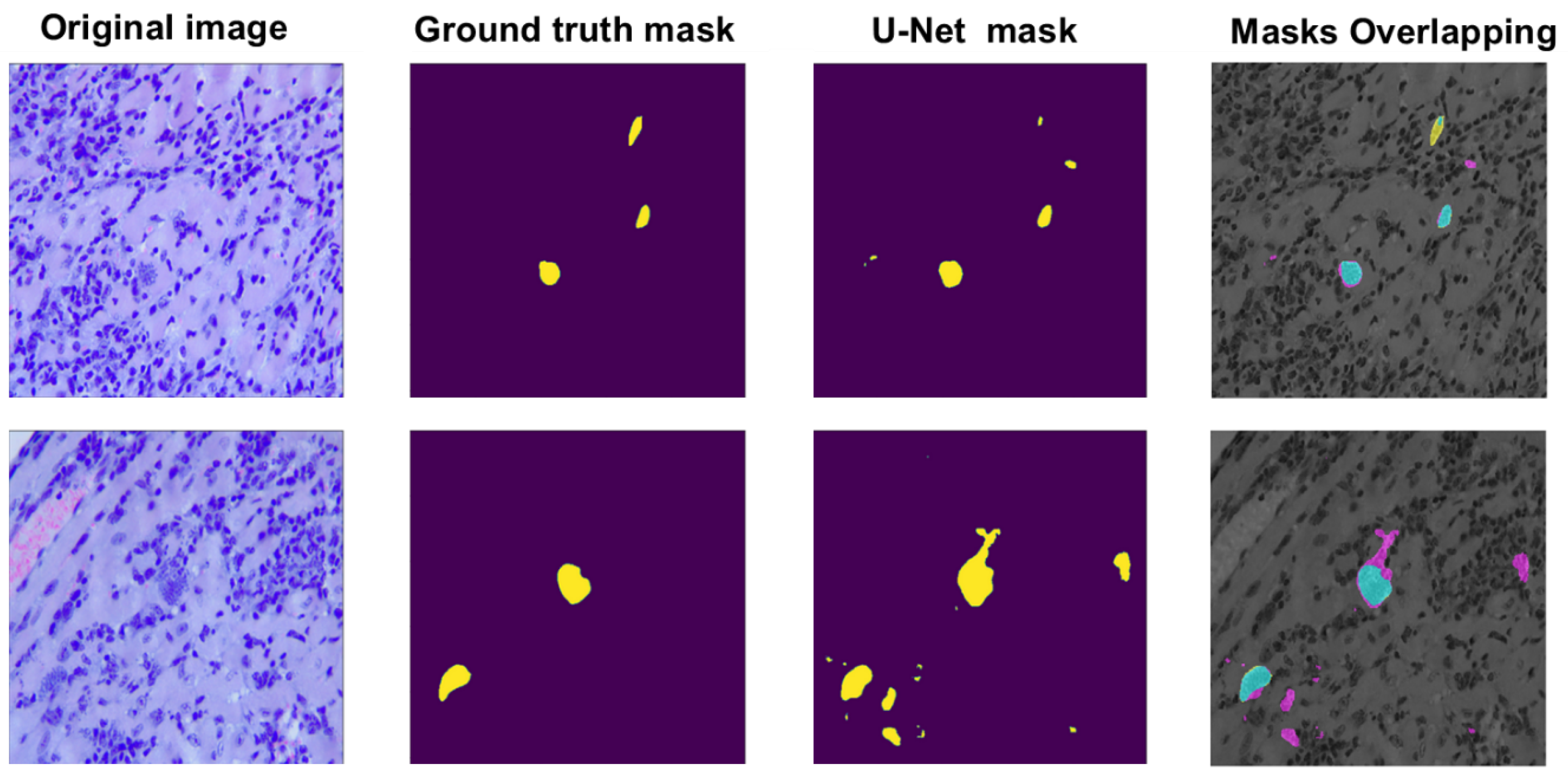 Deep Learning–Based Segmentation of Trypanosoma cruzi Nests in Histopathological Images