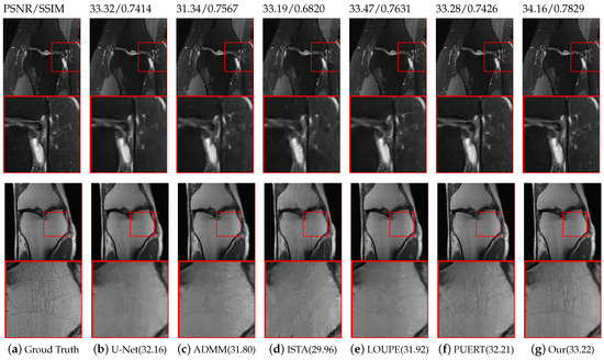Learing Sampling and Reconstruction Using Bregman Iteration for CS-MRI