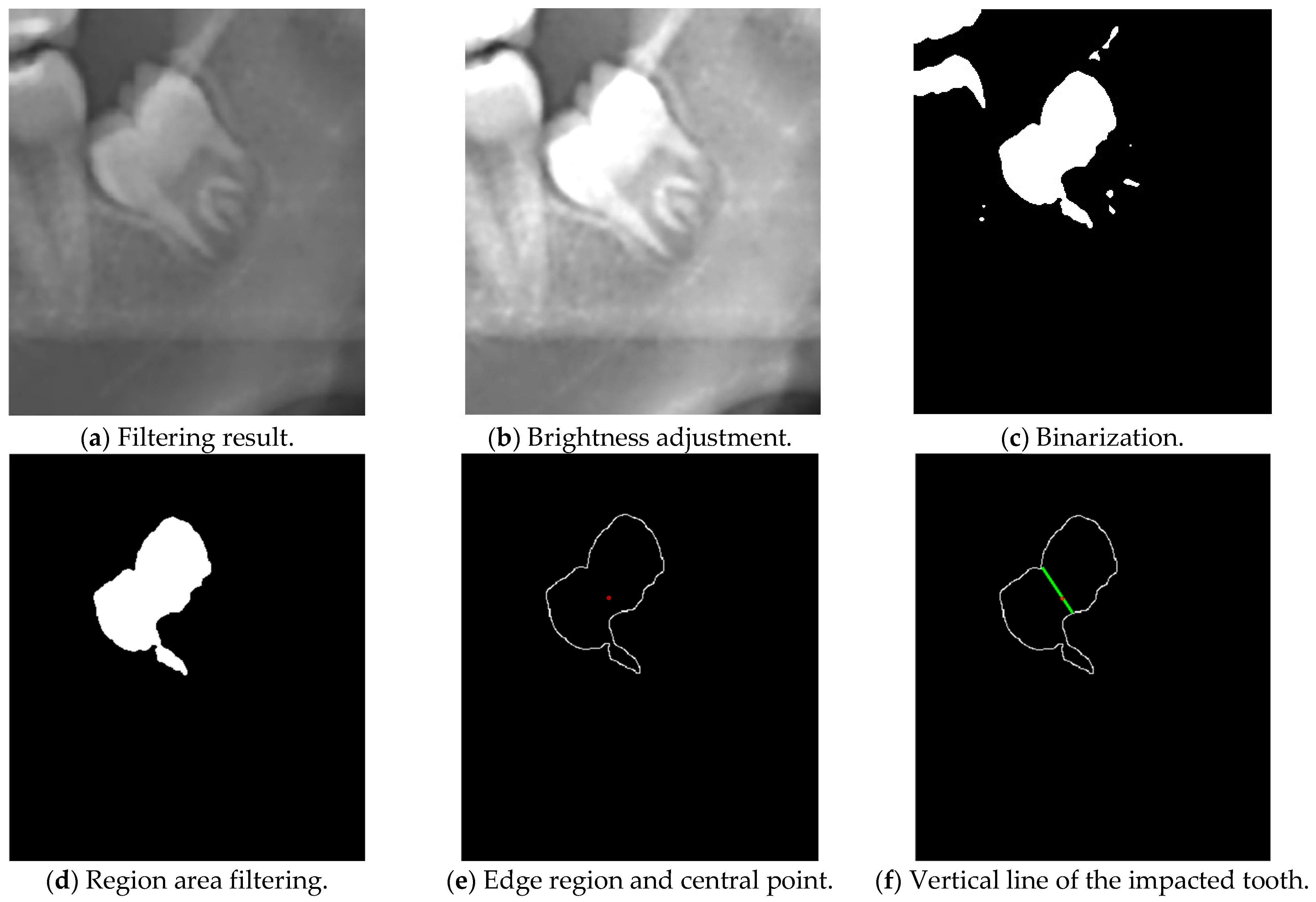 Classification of the Relative Position between the Third Molar and the ...