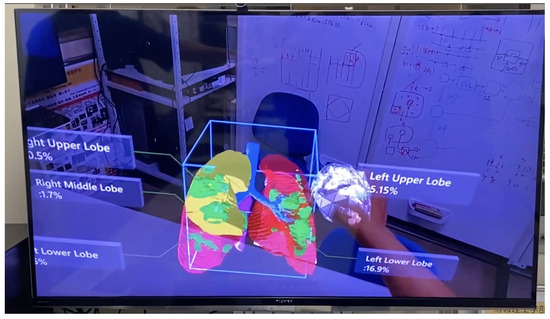 Augmented Reality Visualization and Quantification of COVID-19 ...