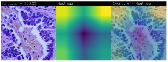 An Explainable Method for Lung Cancer Detection and Localisation from ...
