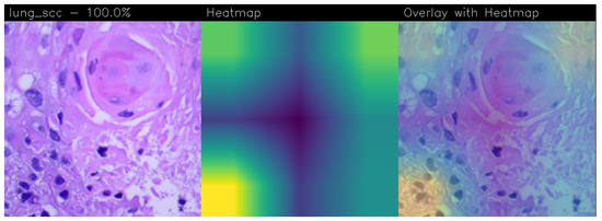 An Explainable Method for Lung Cancer Detection and Localisation from ...