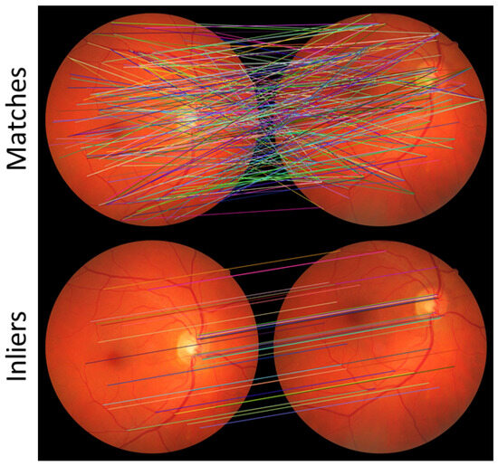 Enhanced Vascular Bifurcations Mapping: Refining Fundus Image Registration