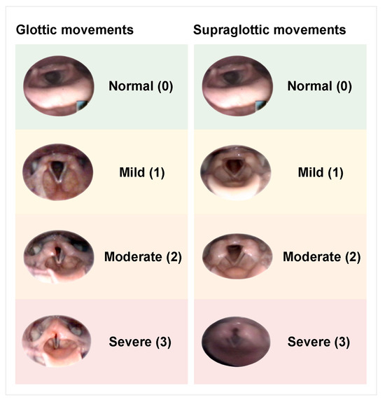 Diagnostics of Exercise-Induced Laryngeal Obstruction Using Machine ...