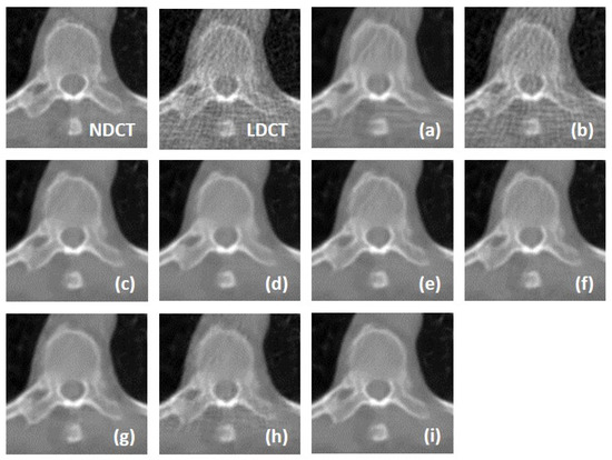 WaveletDFDS-Net: A Dual Forward Denoising Stream Network for Low-Dose ...
