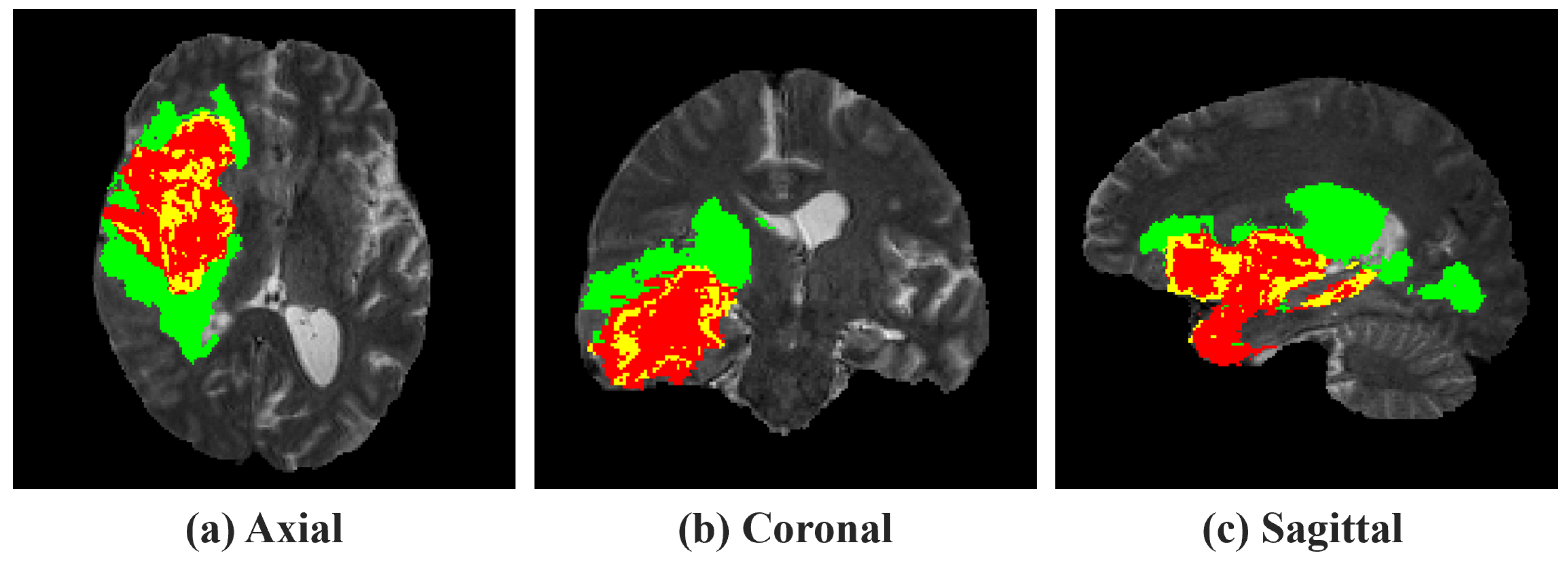 TACA-RNet: Tri-Axis Based Context-Aware Reverse Network for Multimodal Brain Tumor Segmentation