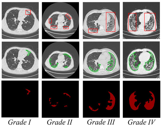 Multitask Learning for Concurrent Grading Diagnosis and Semi-Supervised ...