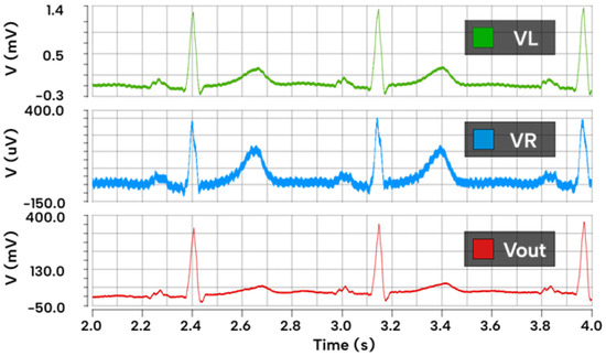 Design and Analysis of a High-Gain, Low-Noise, and Low-Power Analog ...