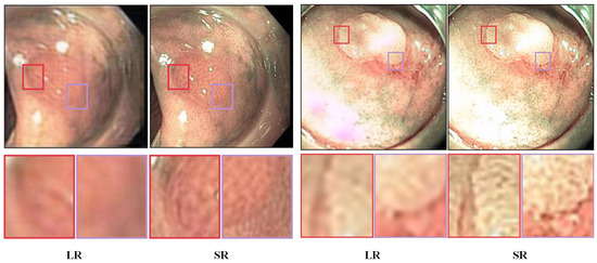 Colorectal Polyp Detection Model by Using Super-Resolution ...