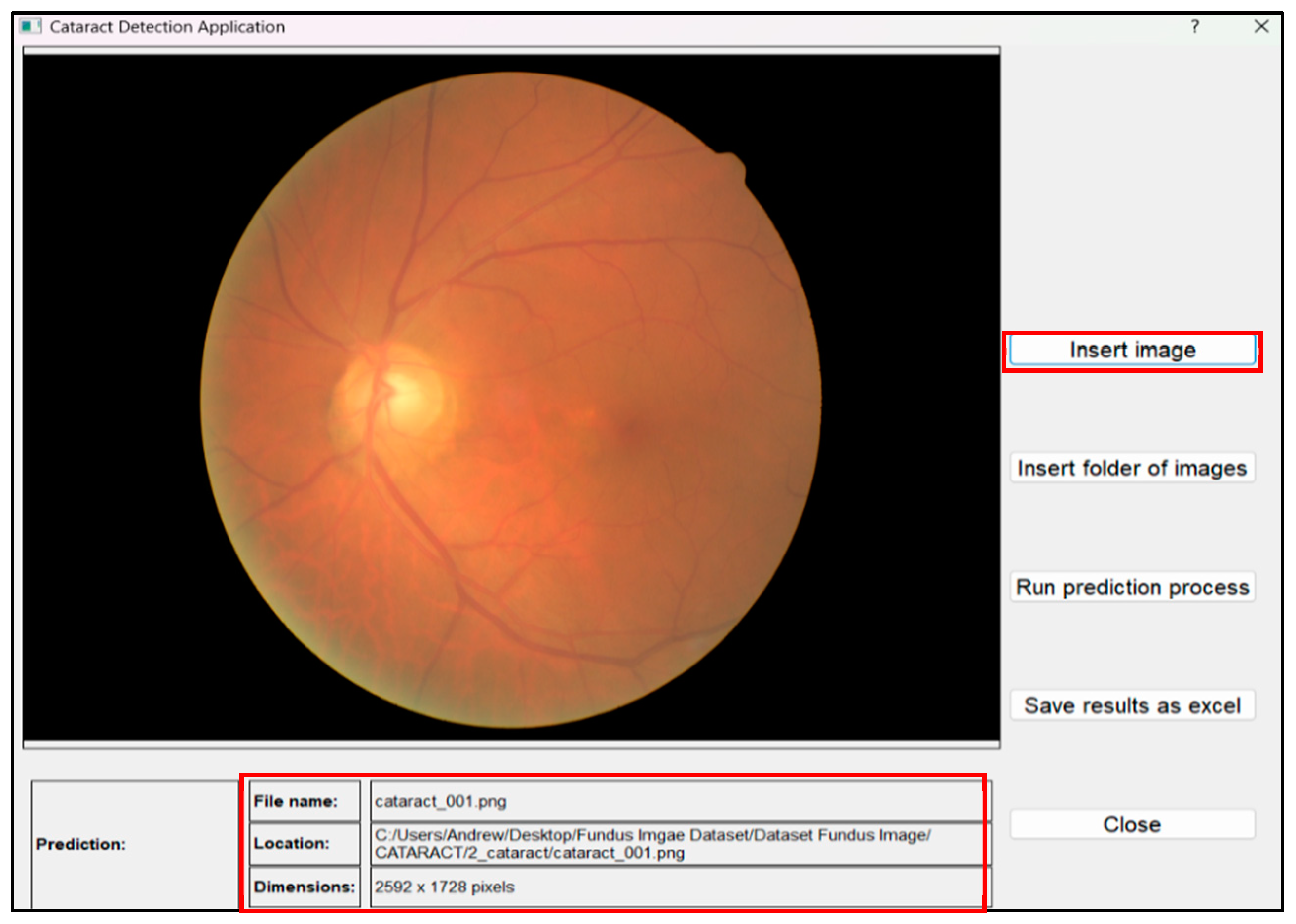 Electronics | Free Full-Text | Enhancing Cataract Detection through ...
