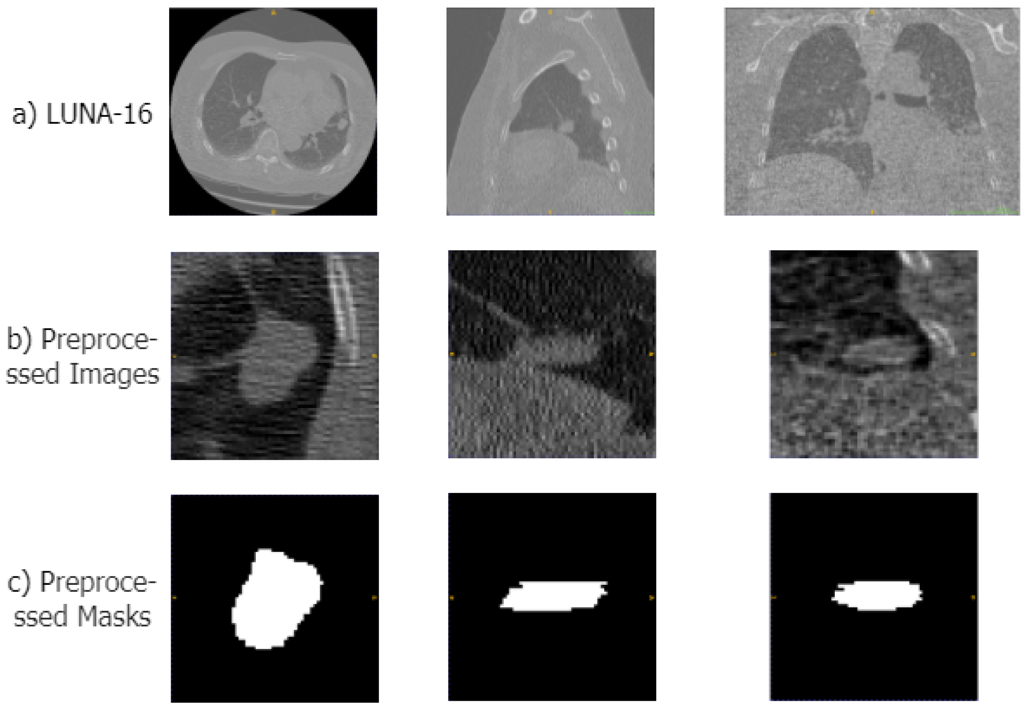 ALKU-Net: Adaptive Large Kernel Attention Convolution Network for Lung Nodule Segmentation