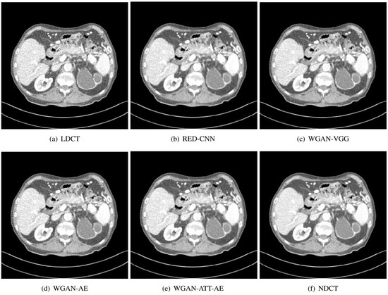 Electronics | Free Full-Text | Innovative Noise Extraction and Denoising in Low-Dose CT Using a ...