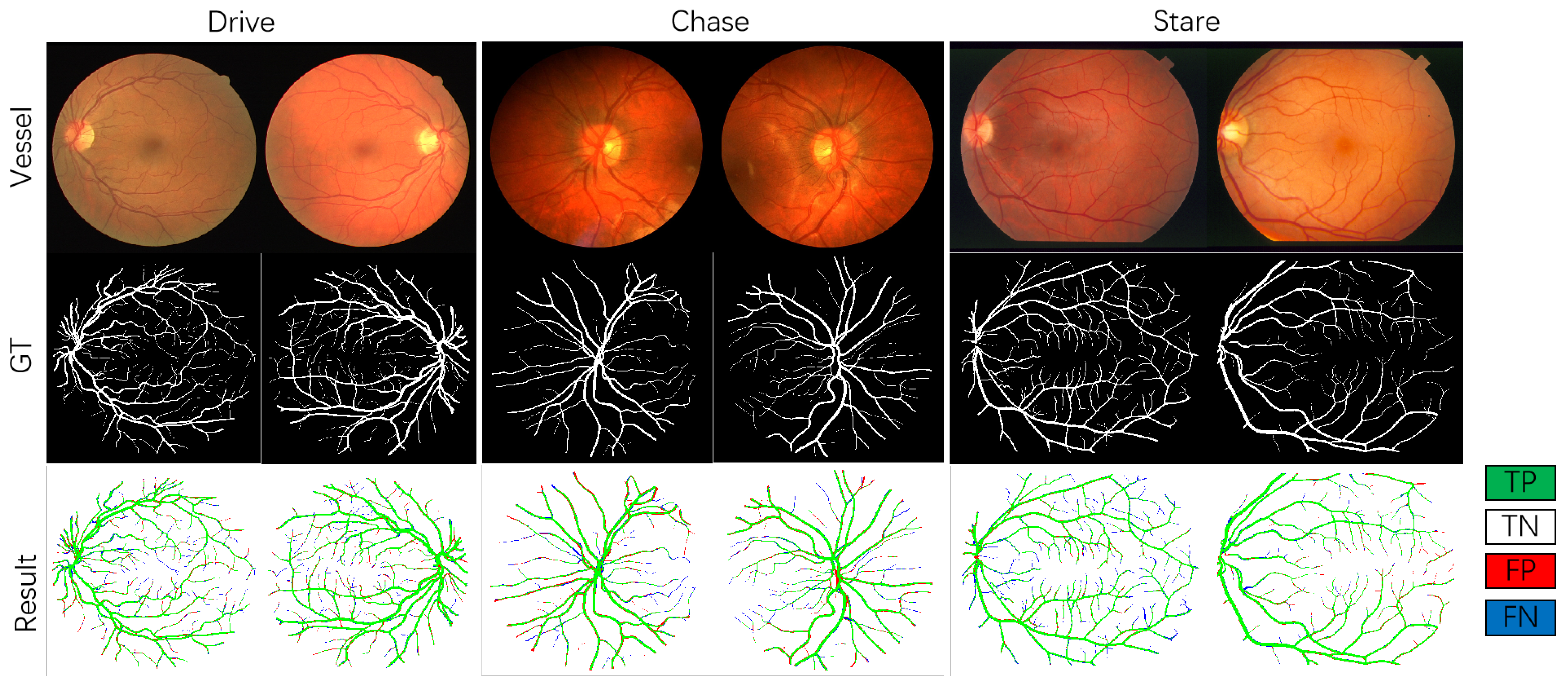 Retinal Vessel Segmentation Based on Self-Attention Feature Selection