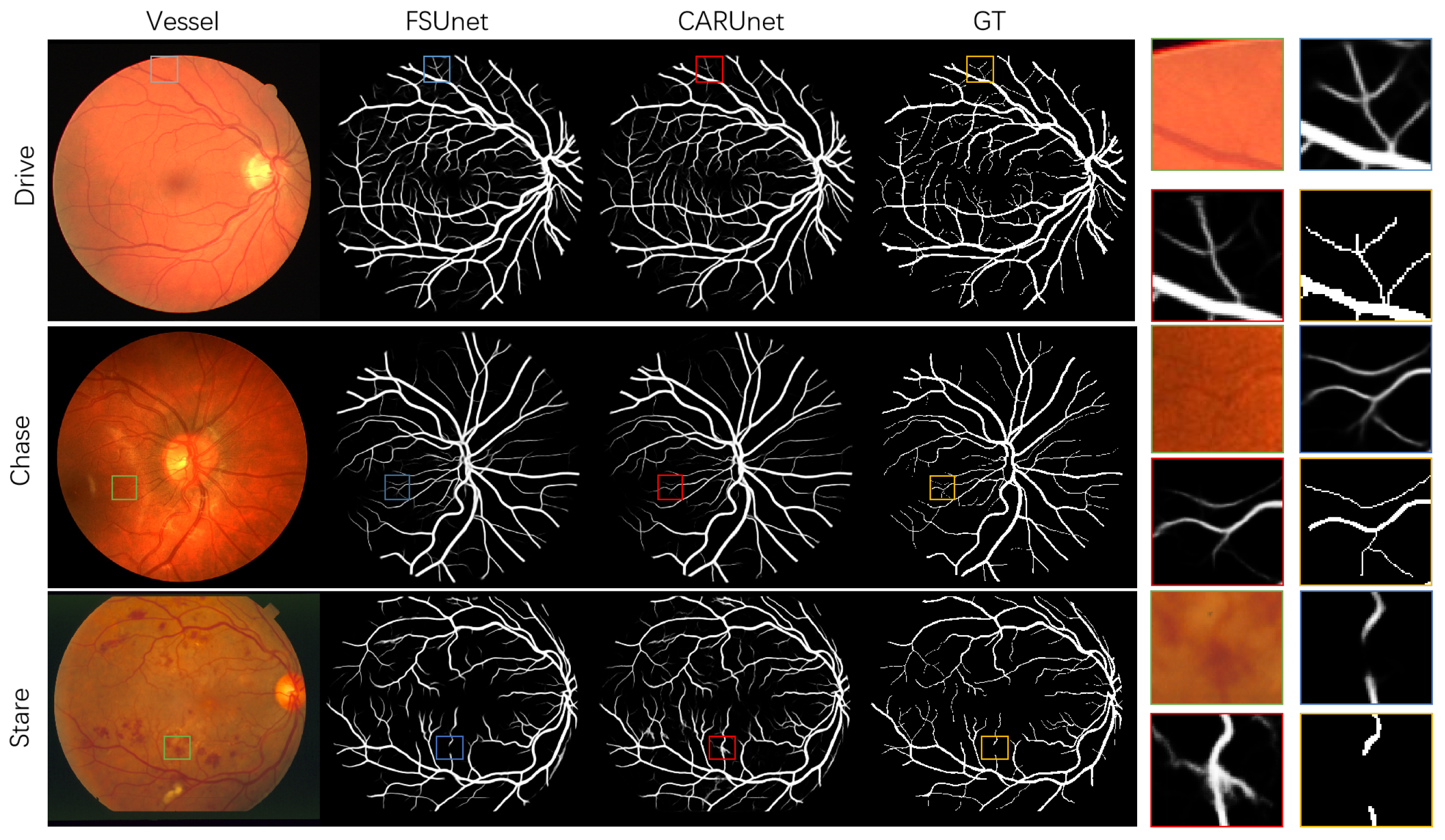 Retinal Vessel Segmentation Based on Self-Attention Feature Selection