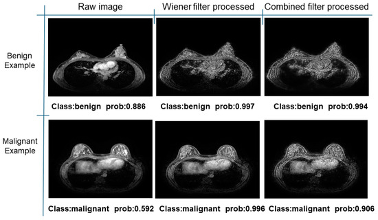 Early Breast Cancer Detection Using Artificial Intelligence Techniques ...