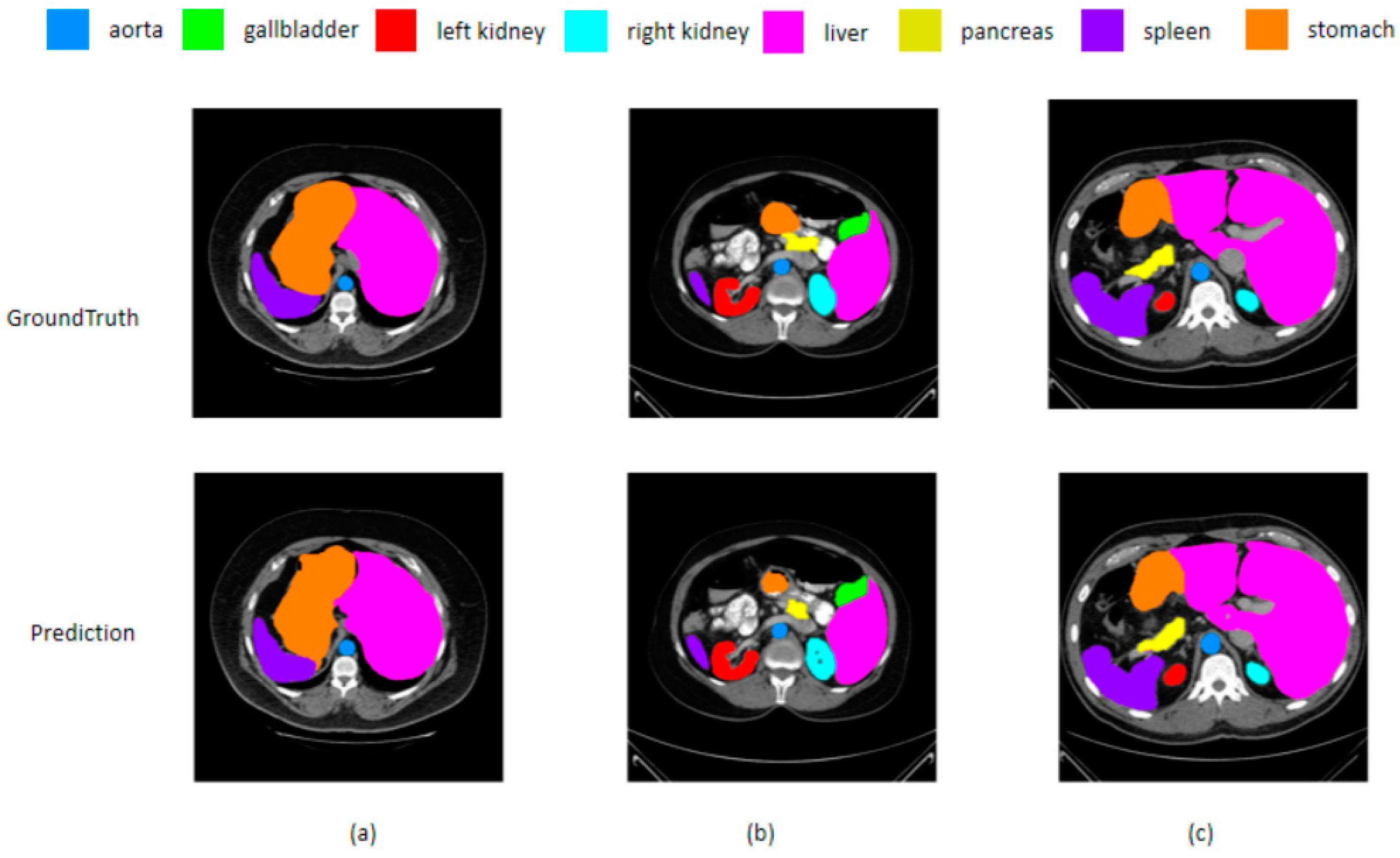 ShiftTransUNet: An Efficient Deep Learning Model for Medical Image Segmentation Using ShiftViT ...
