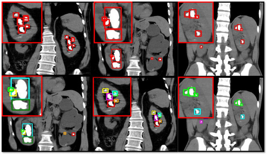 Optimized YOLOv5 Architecture for Superior Kidney Stone Detection in CT Scans