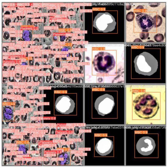 Blood Cell Target Detection Based on Improved YOLOv5 Algorithm