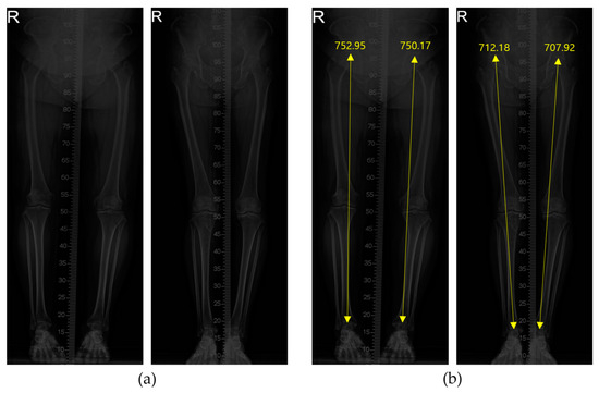 Automatic Lower-Limb Length Measurement Network (A3LMNet): A Hybrid Framework for Automated ...