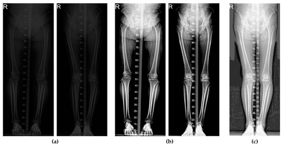 Automatic Lower-Limb Length Measurement Network (A3LMNet): A Hybrid ...