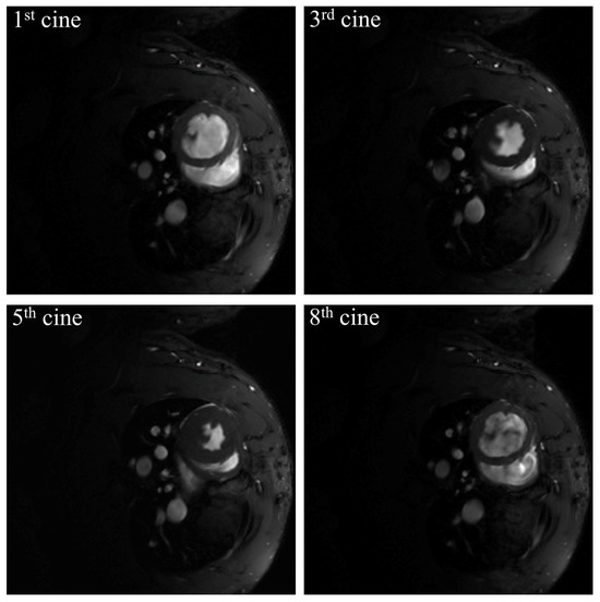 Investigation of Blind Deconvolution Method with Total Variation ...