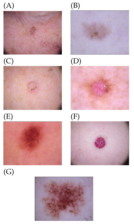 Deep Learning Approaches for Skin Lesion Detection