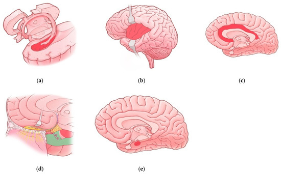 Limbic Encephalitis Associated with COVID-19