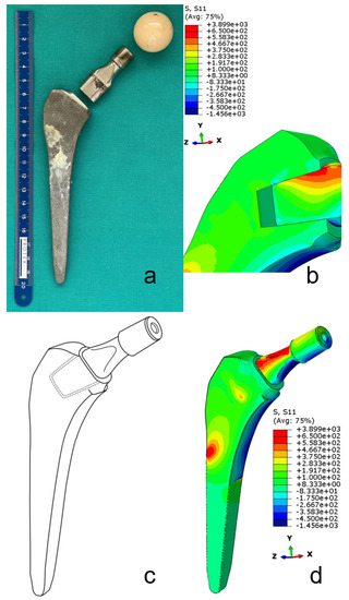 Dual-Modular Stems for Primary Total Hip Arthroplasty