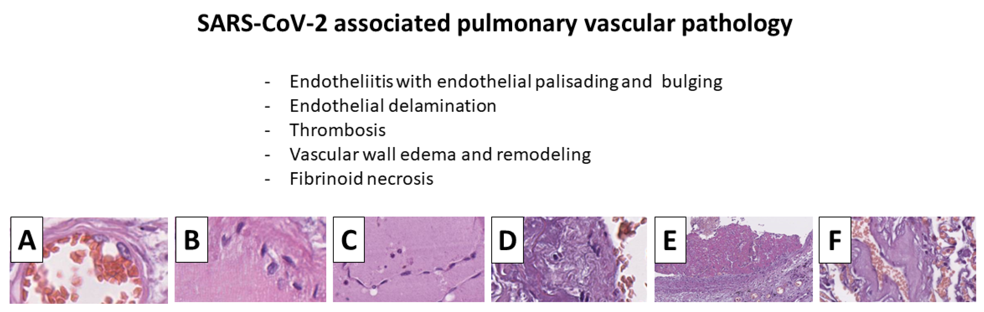 SARS-CoV-2 Associated Pulmonary Pathology