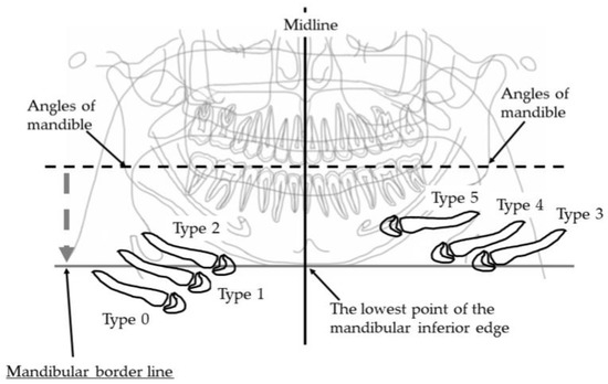 Hyoid Bone Panoramic X Ray