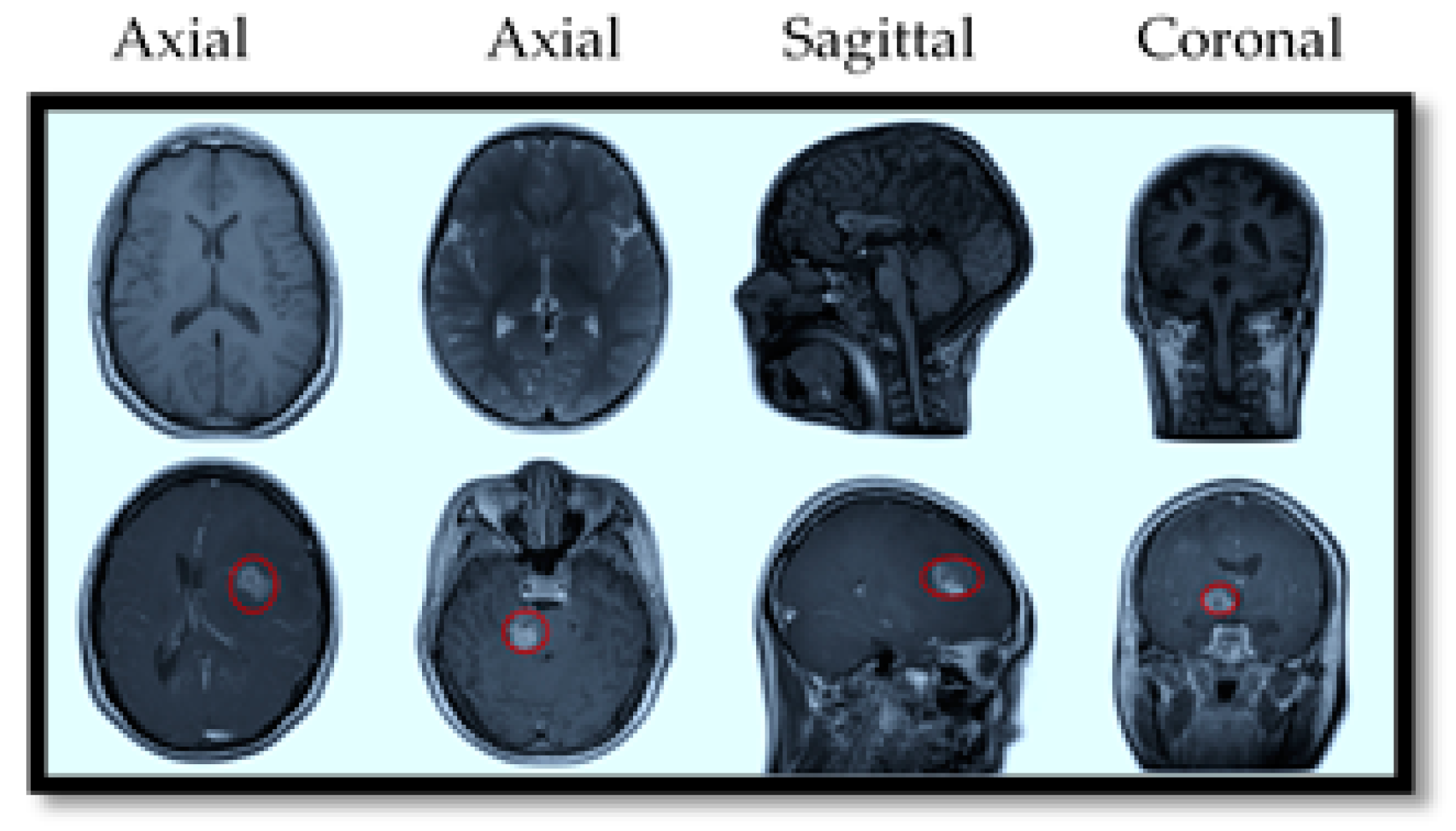 Advancing Brain Tumor Analysis: Current Trends, Key Challenges, and ...