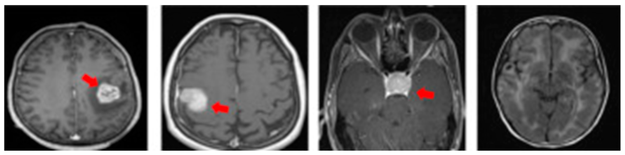 Advancing Brain Tumor Analysis: Current Trends, Key Challenges, and ...