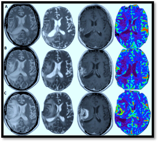 Advancing Brain Tumor Analysis: Current Trends, Key Challenges, and Perspectives in Deep ...