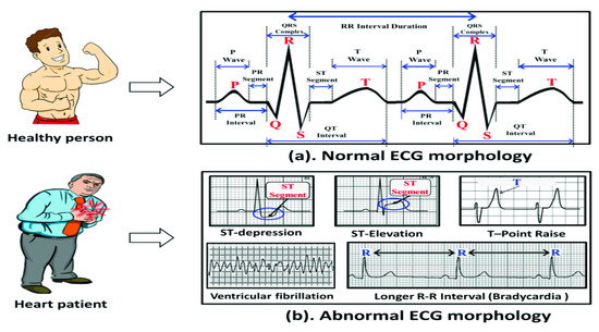 An Efficient Designing of IIR Filter for ECG Signal Classification ...