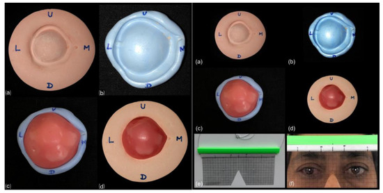 Facial and Smile Symmetry: Customized Iris Positioning Device for ...