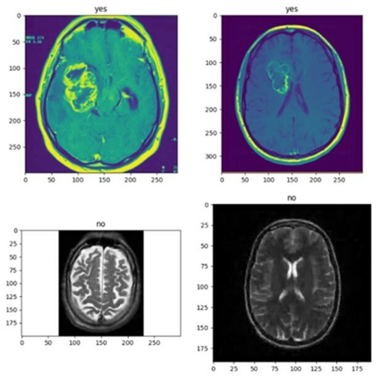The VGG16 Method Is a Powerful Tool for Detecting Brain Tumors Using Deep Learning Techniques