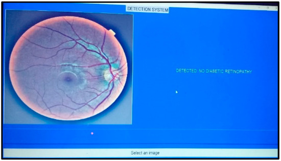 Intraocular Pressure Monitoring System for Glaucoma Patients Using IoT and Machine Learning