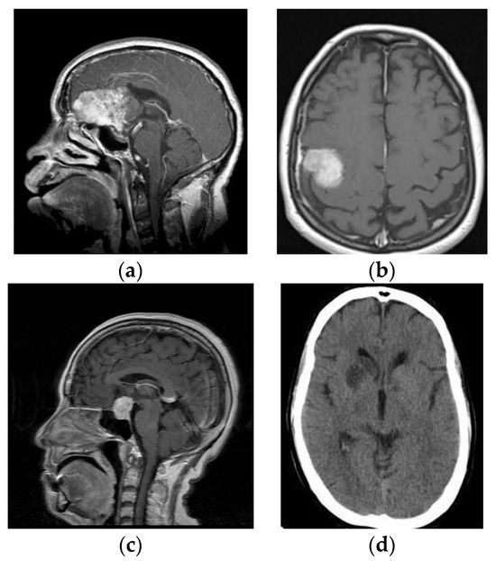 Brain Tumor Detection and Classification Using Transfer Learning Models