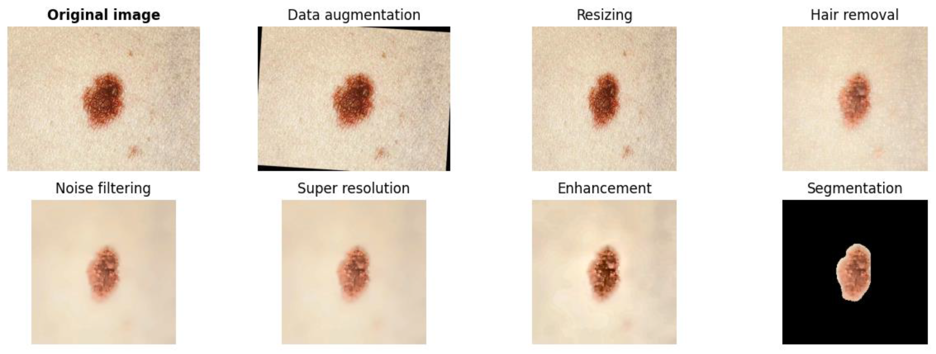 NevusCheck: A Dysplastic Nevi Detection Model Using Convolutional Neural Networks